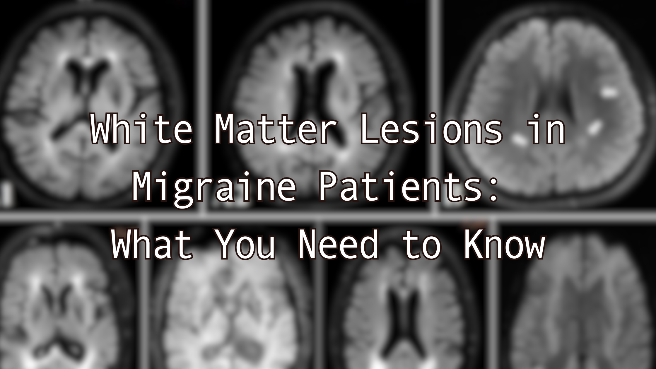 White Matter Lesions in Migraine Patients: What You Need to Know ...