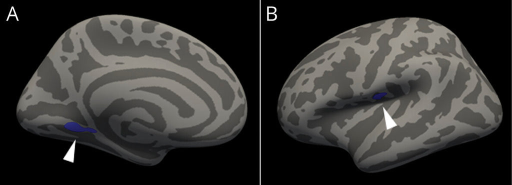 MRI Study Reveals Brain Differences in Patients with Migraine, Offerin ...